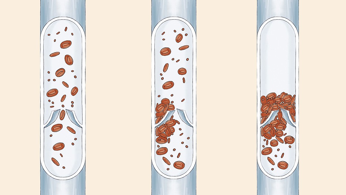 Thrombose veineuse profonde | medibelgium.be